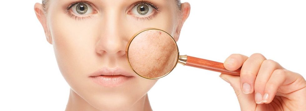 Elimina tus manchas con la técnica revolucionaria del láser azul - Milesman