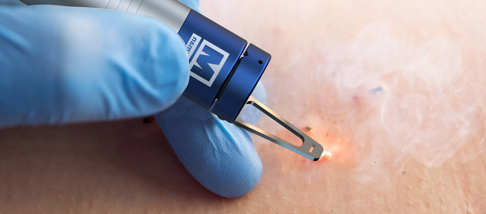 Todo sobre el láser azul - Milesman