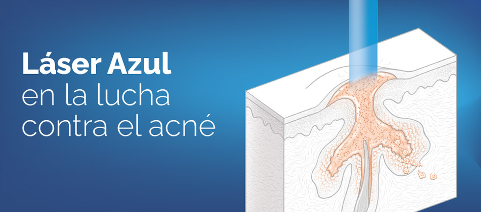 Láser azul en la lucha contra el acné - Milesman