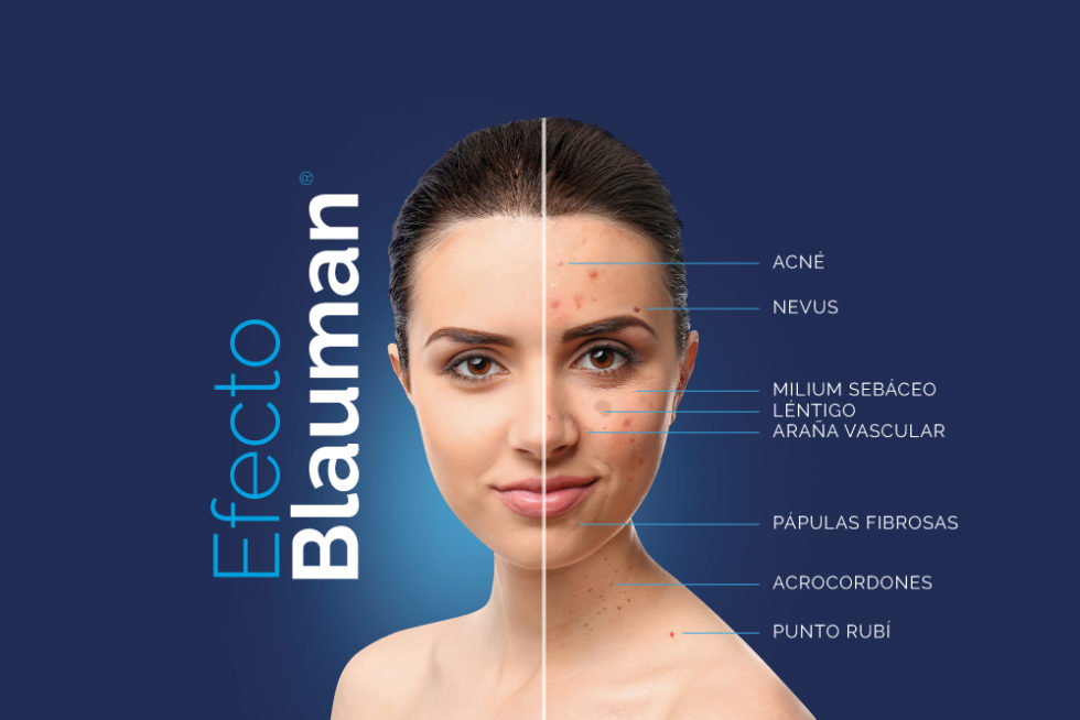 Dudas frecuentes al adquirir un láser azul - Milesman