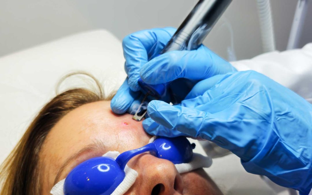 Principales ventajas del Láser Azul Blauman en la Estética - Milesman