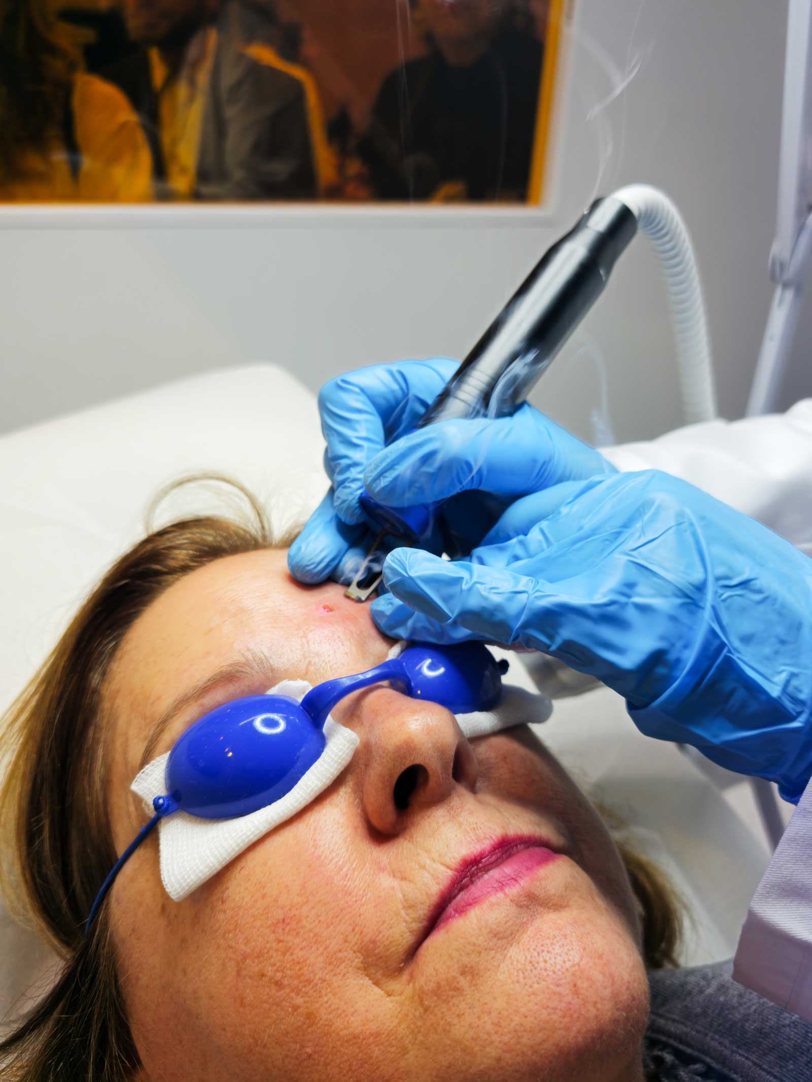 Principales ventajas del Láser Azul Blauman en la Estética - Milesman